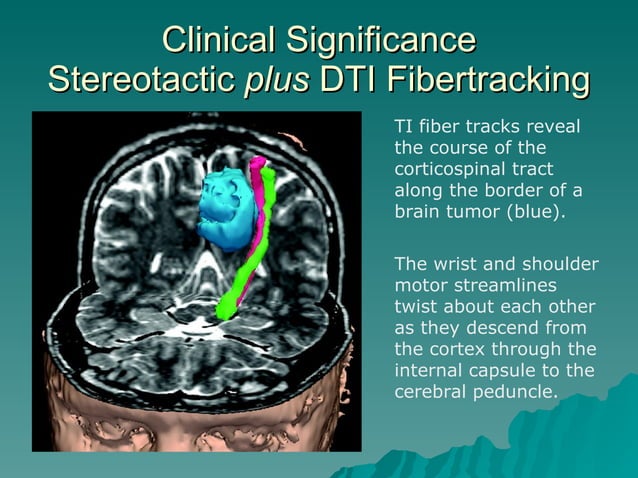 DTI Fiber Tracking | PPT