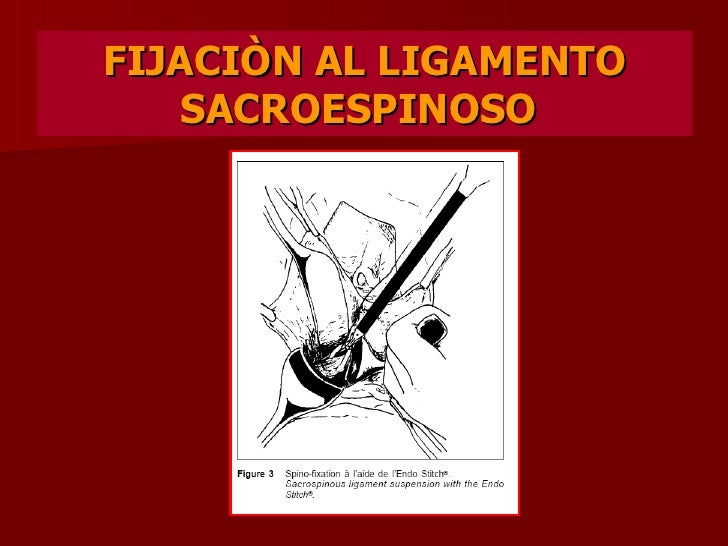 PROLAPSO GENITAL FEMENINO Y LOS DEFECTOS DEL DEGMENTO APICAL