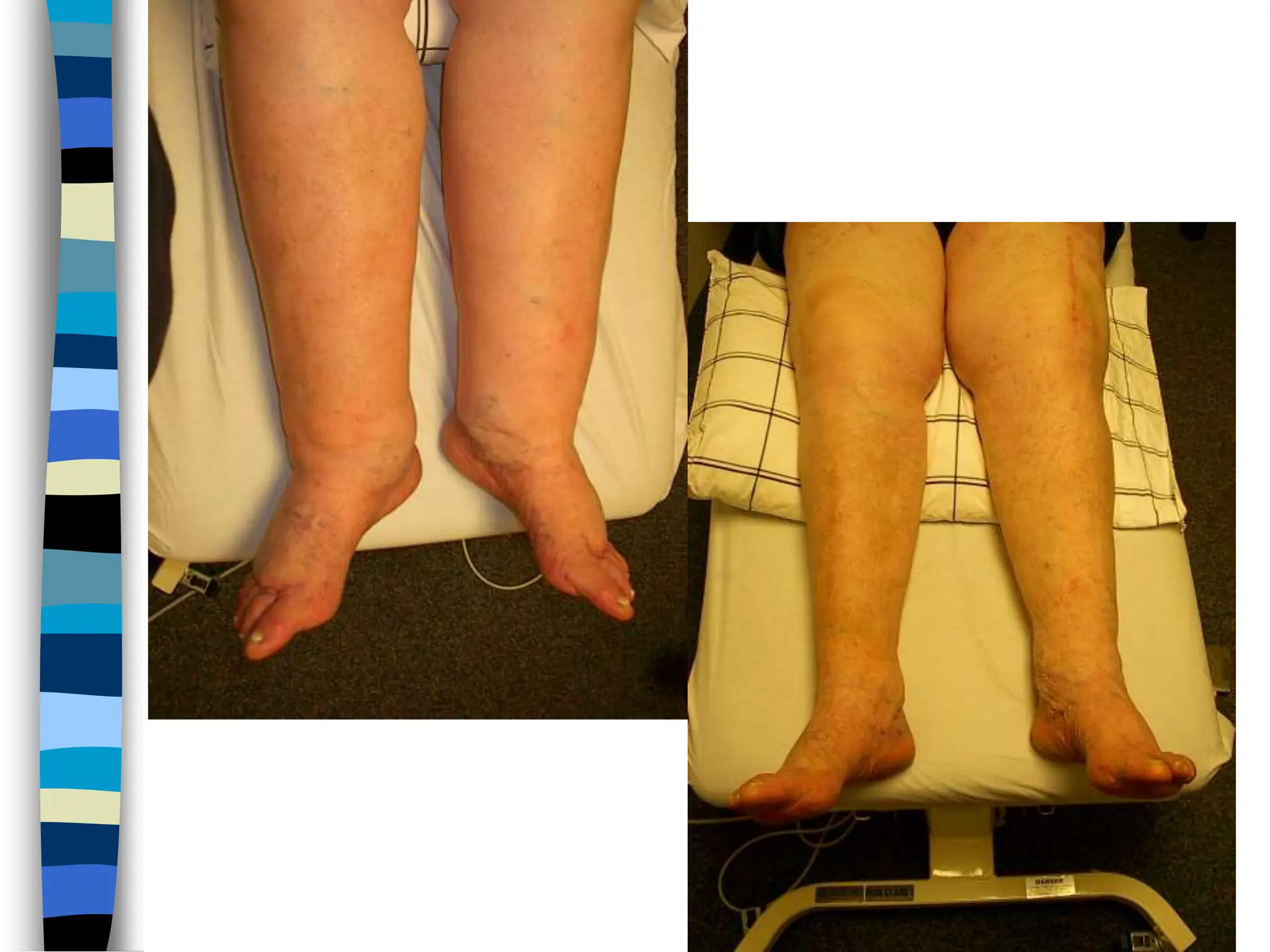 CDT-Edema-Therapy-in-Wound-Care.ppt