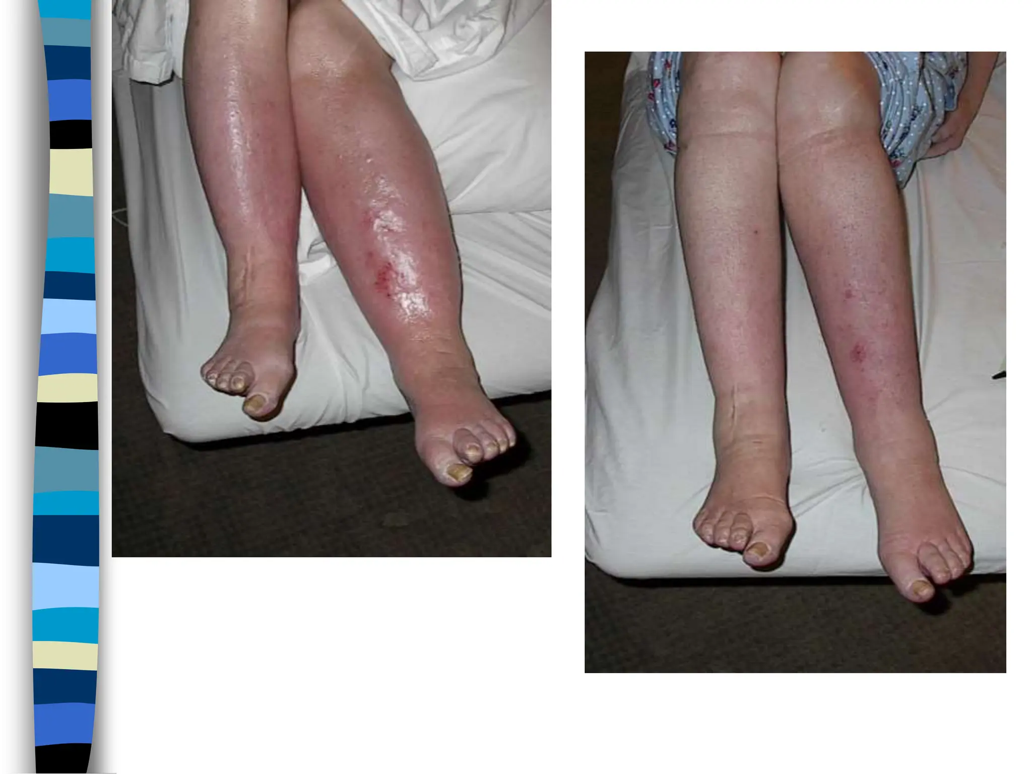 CDT-Edema-Therapy-in-Wound-Care.ppt