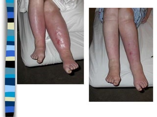 CDT-Edema-Therapy-in-Wound-Care.ppt