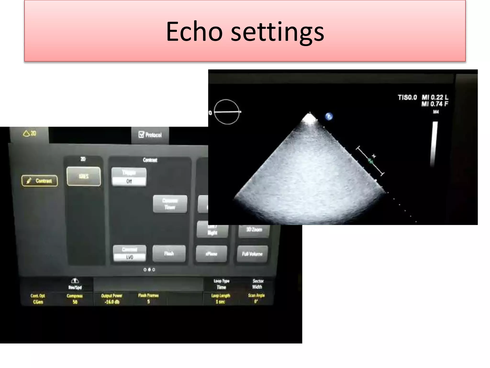 Contrast Echocardiography | PPTX