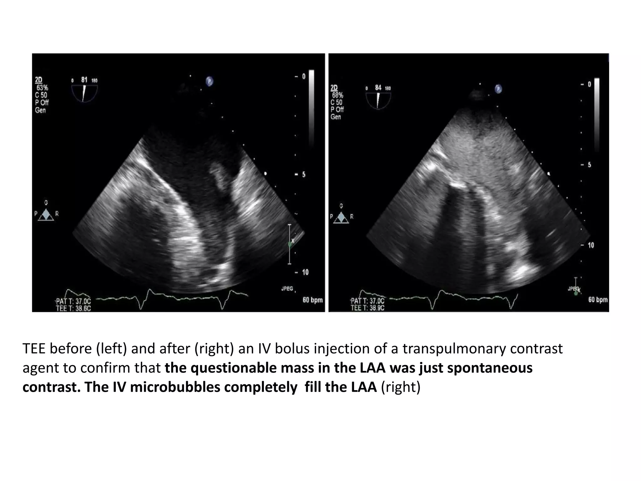 Contrast Echocardiography | PPTX