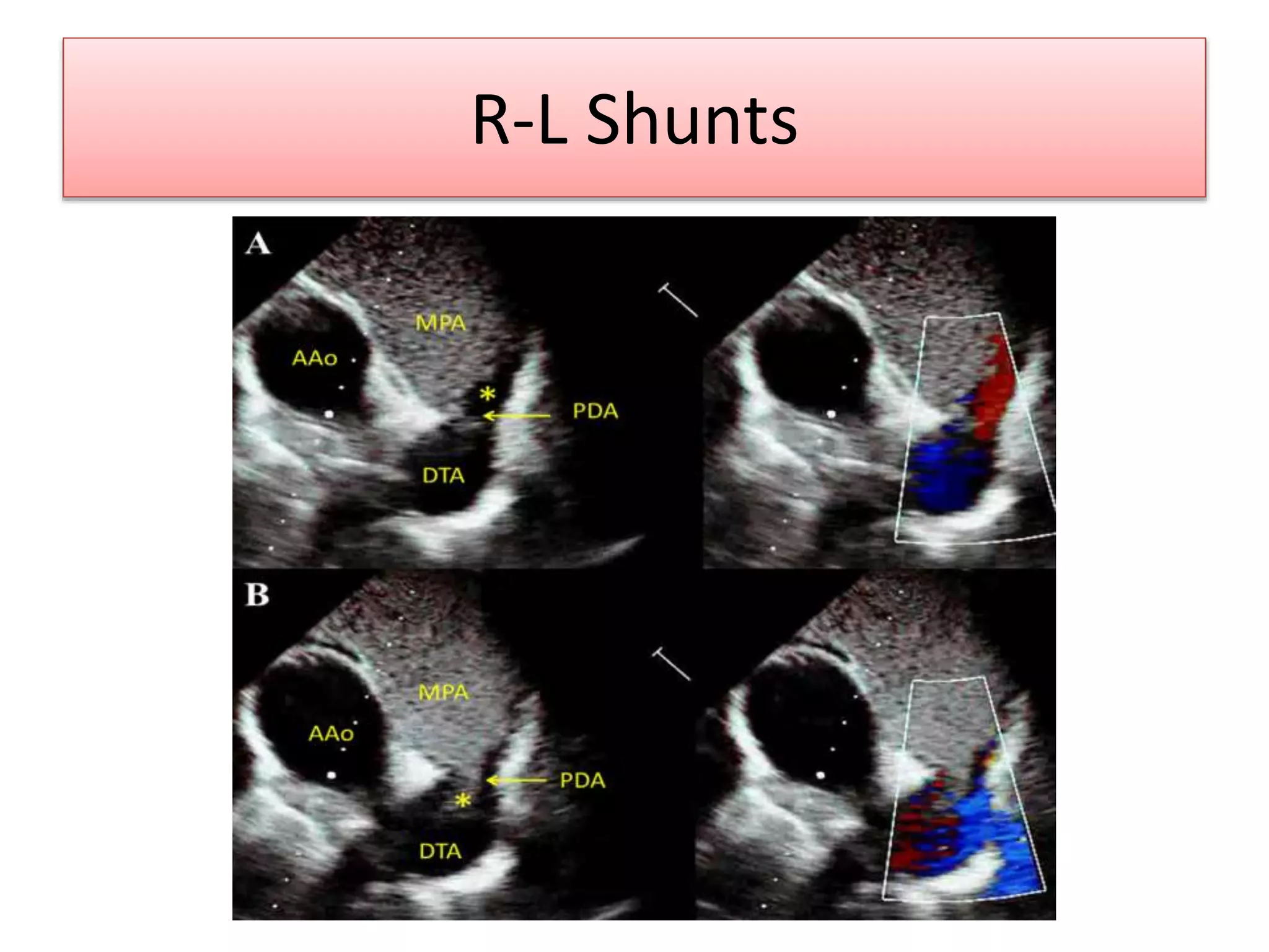 Contrast Echocardiography Pptx