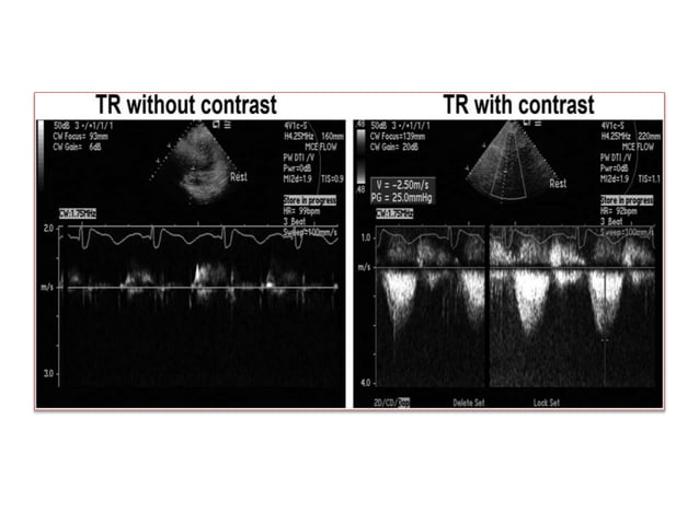 Contrast Echocardiography | PPTX