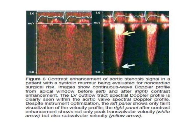 Contrast Echocardiography | PPTX