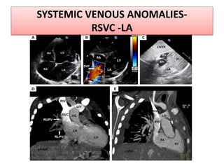 Contrast Echocardiography | PPTX