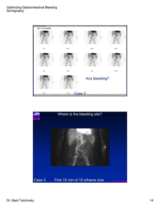 Optimizing Gastrointestinal Bleeding Scintigraphy | PDF | Digestive ...