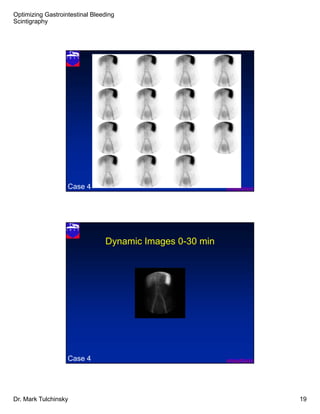 Optimizing Gastrointestinal Bleeding Scintigraphy | PDF | Digestive ...