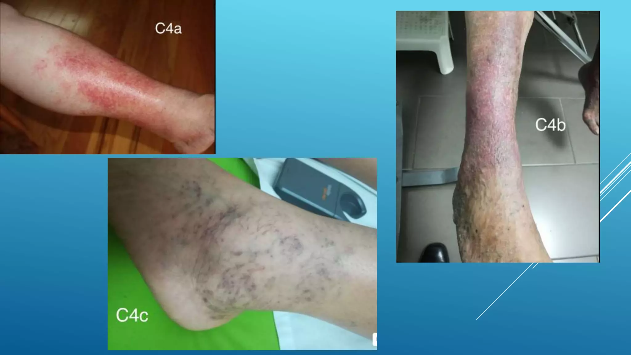 Clasificacion Ceap para varices | PPTX