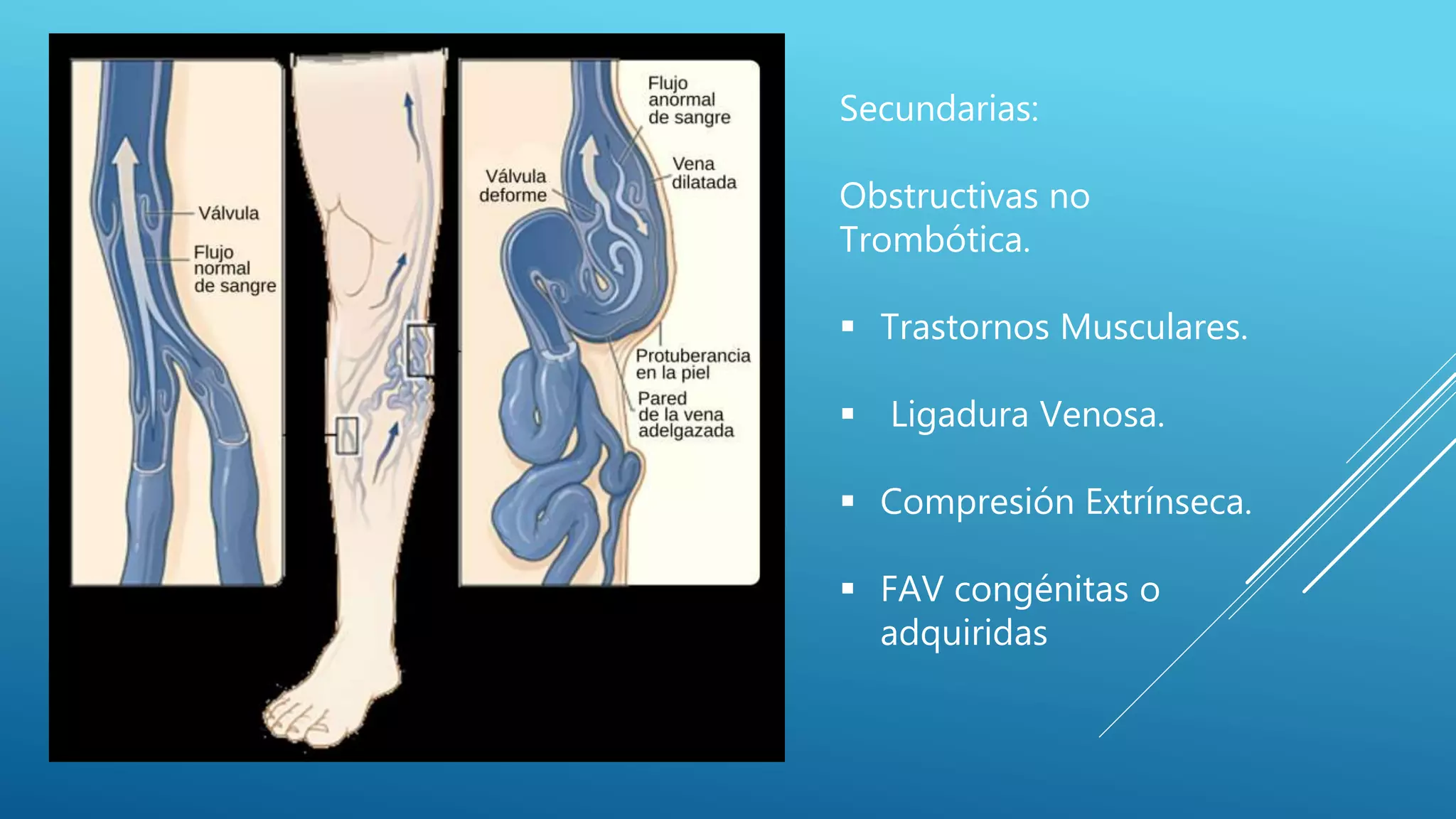 Clasificacion Ceap para varices | PPTX