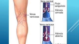 Clasificacion Ceap para varices | PPTX