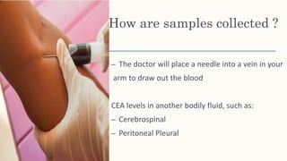 Cea tumor marker | PPTX