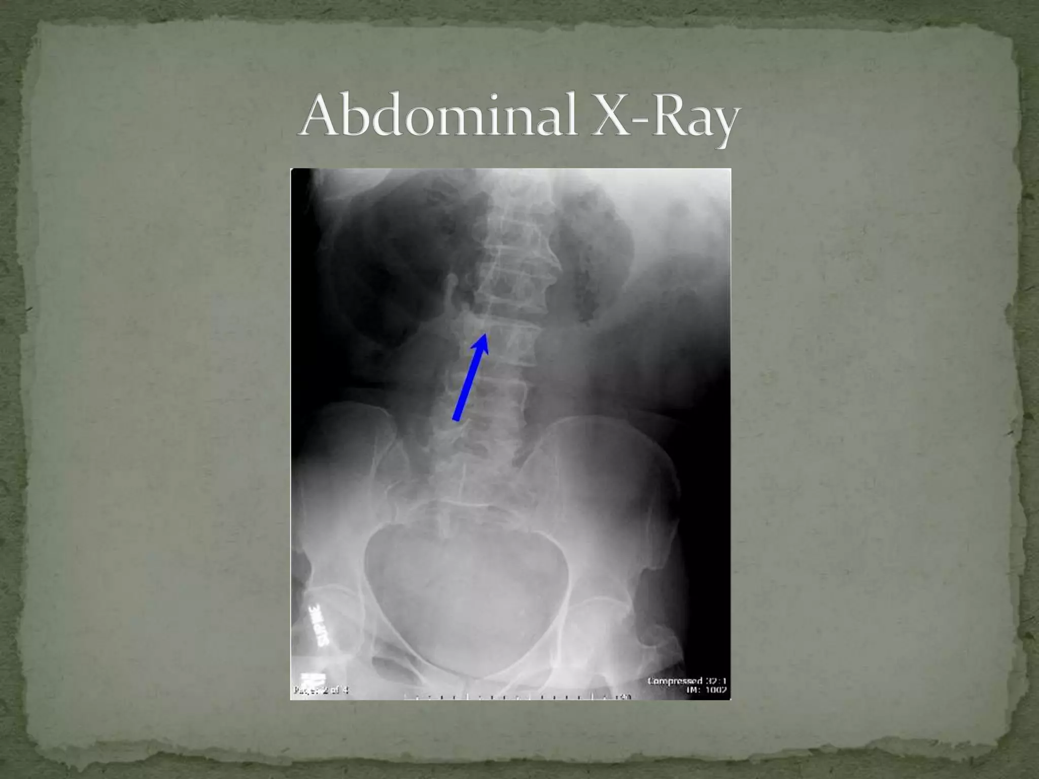 Cecal volvulus | PPTX