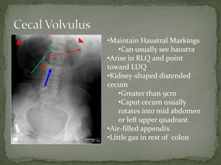 Cecal Volvulus Xray