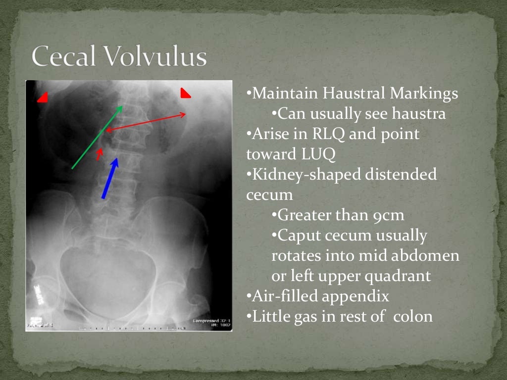 Cecal volvulus Power Point