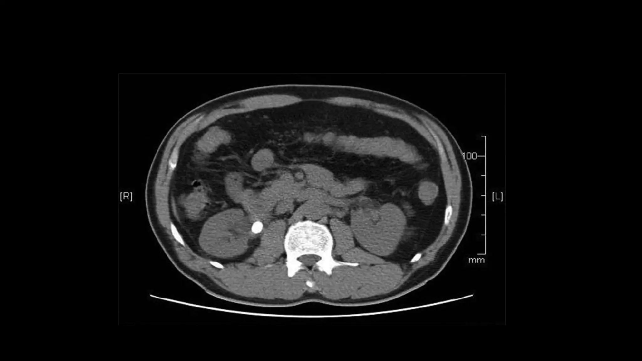 Abdominal CT scan, Triphasic CT scan, Abdominal Anatomy and Hepatobiliary pathology | PPTX