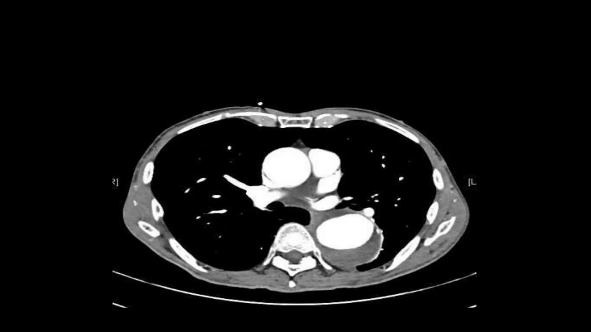 Abdominal Ct Scan Triphasic Ct Scan Abdominal Anatomy And