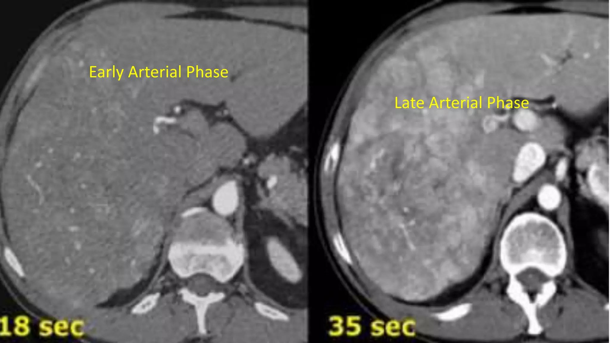 Abdominal CT scan, Triphasic CT scan, Abdominal Anatomy and ...
