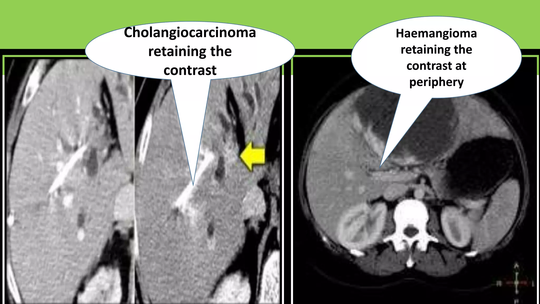 Abdominal CT scan, Triphasic CT scan, Abdominal Anatomy and ...