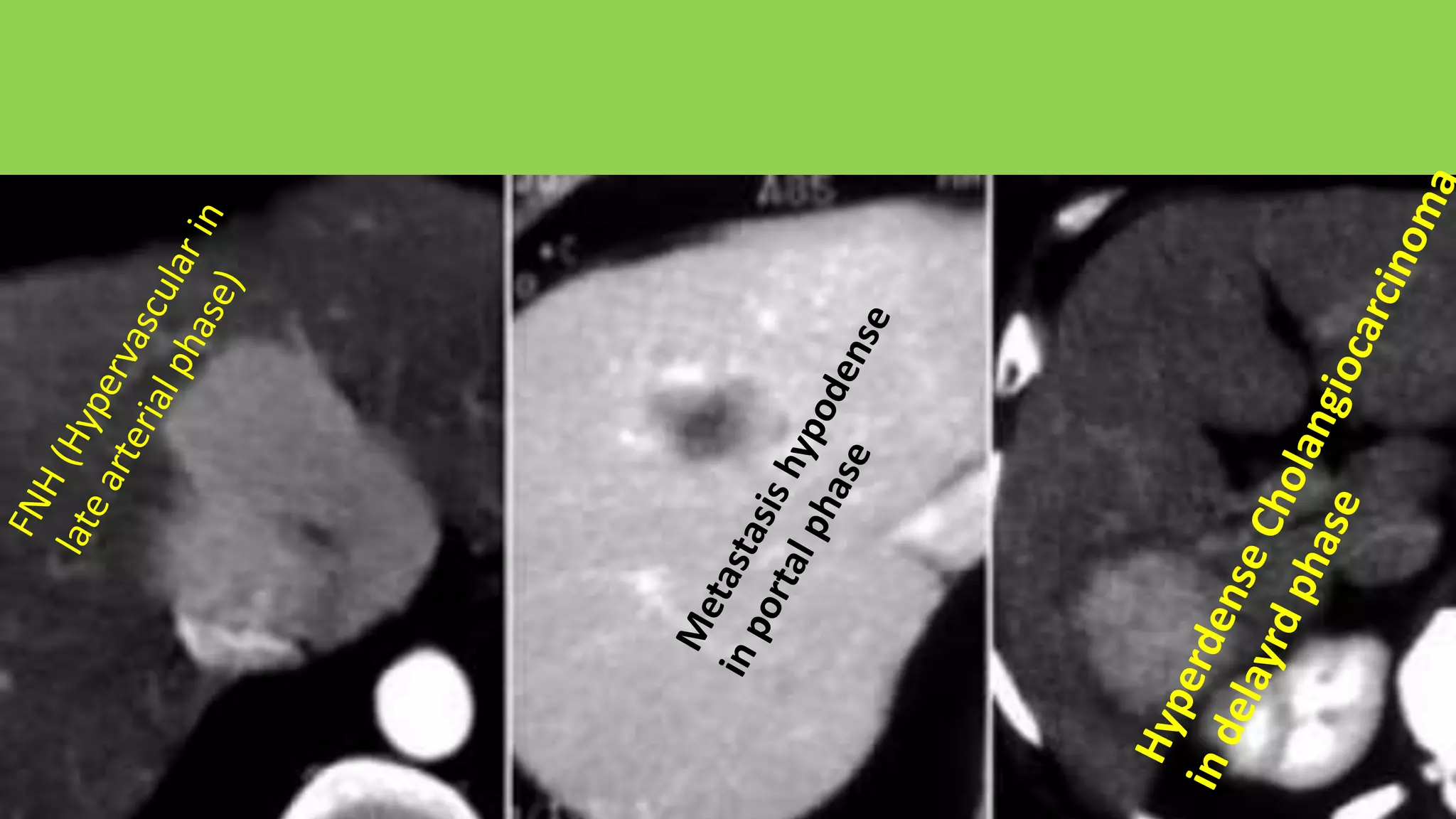 Abdominal CT scan, Triphasic CT scan, Abdominal Anatomy and ...