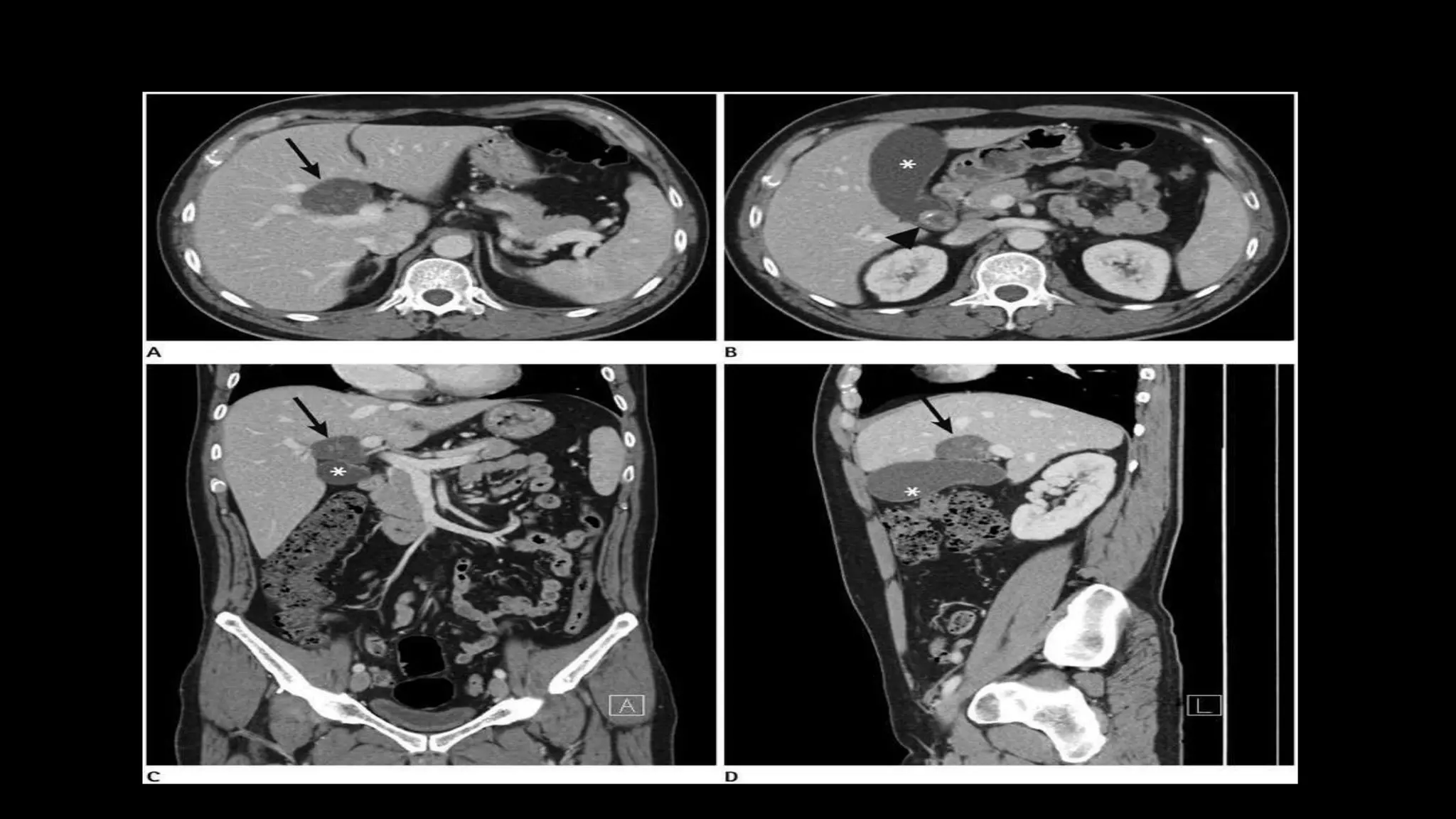 Abdominal CT scan, Triphasic CT scan, Abdominal Anatomy and ...