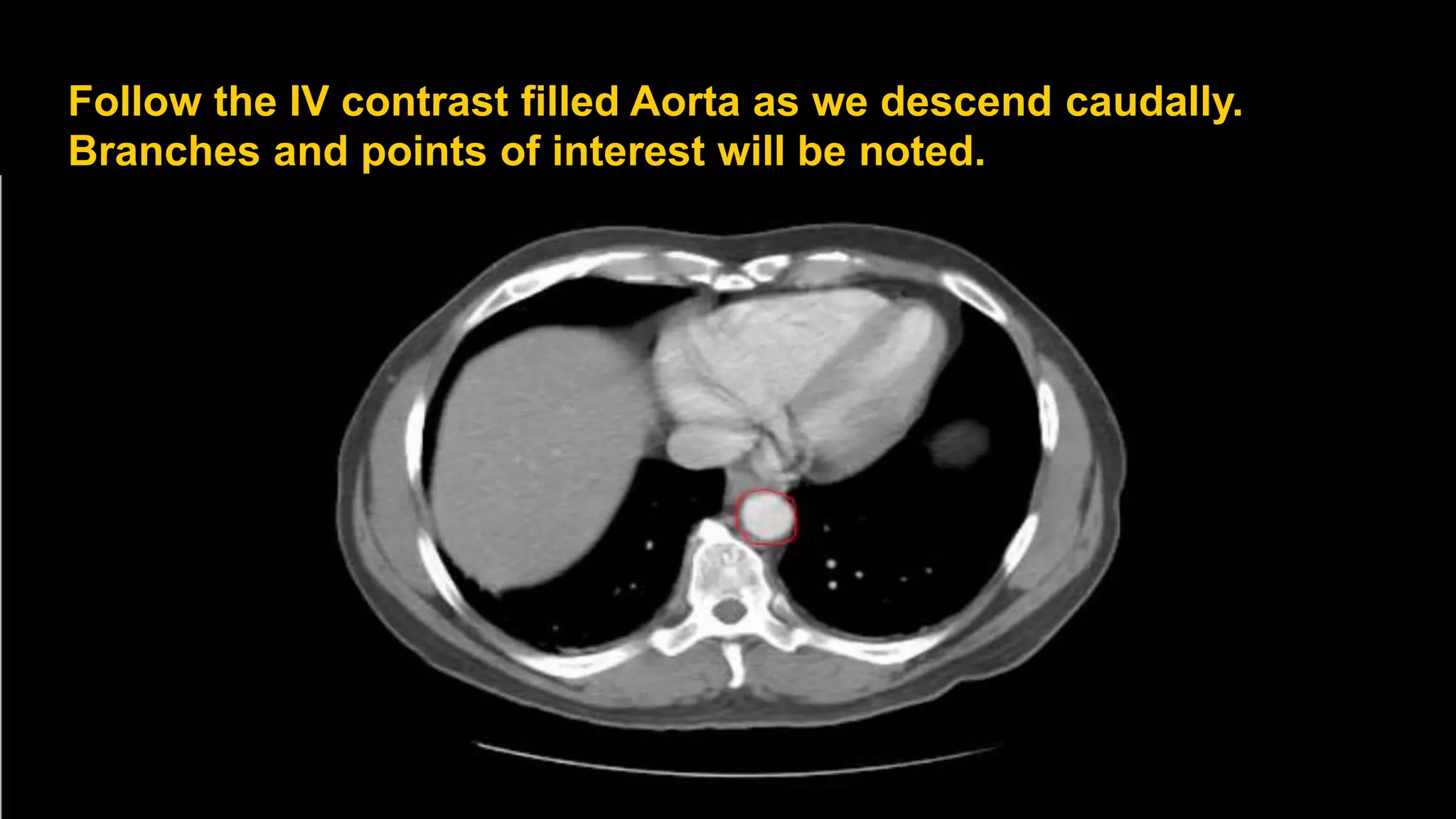 Abdominal CT scan, Triphasic CT scan, Abdominal Anatomy and ...