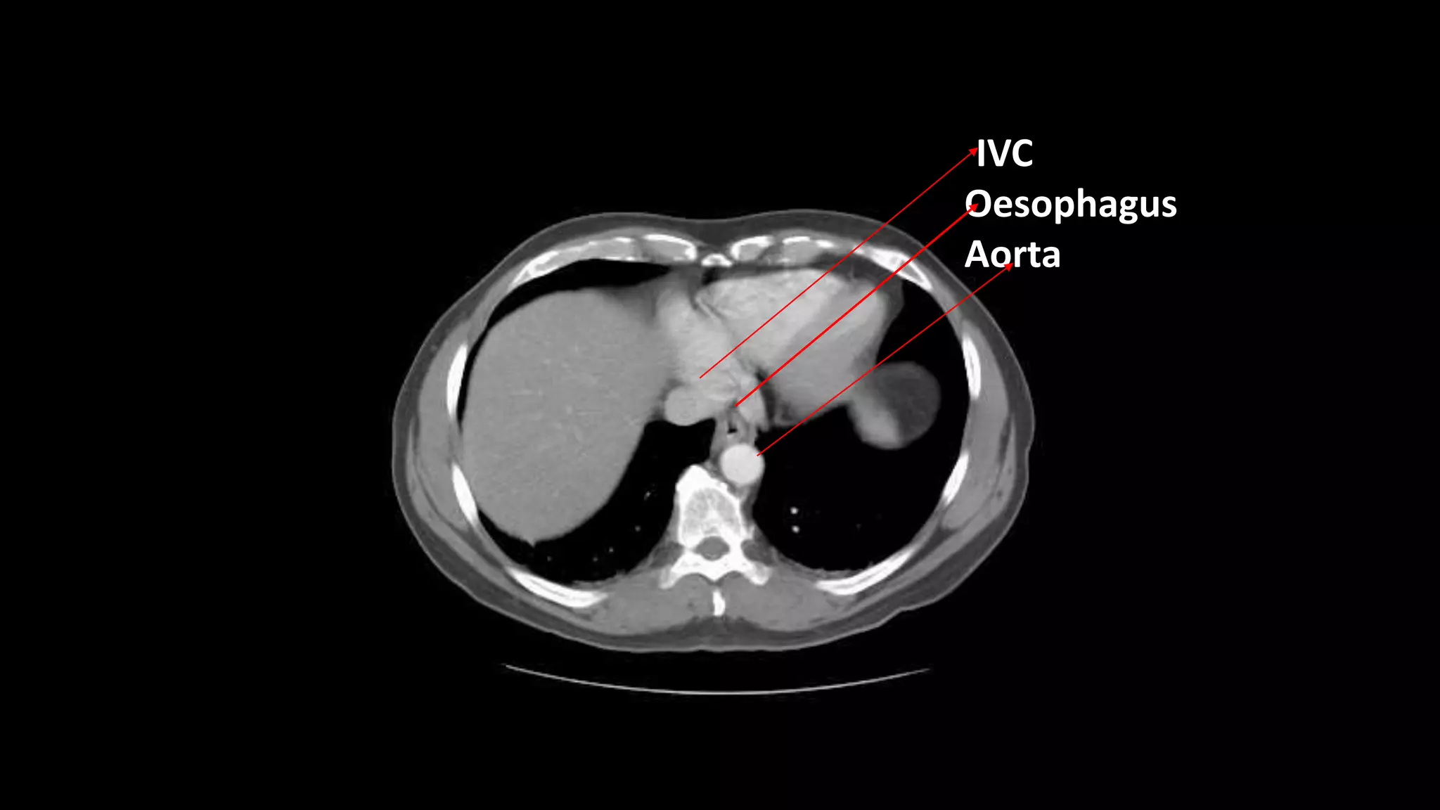 Abdominal CT scan, Triphasic CT scan, Abdominal Anatomy and ...