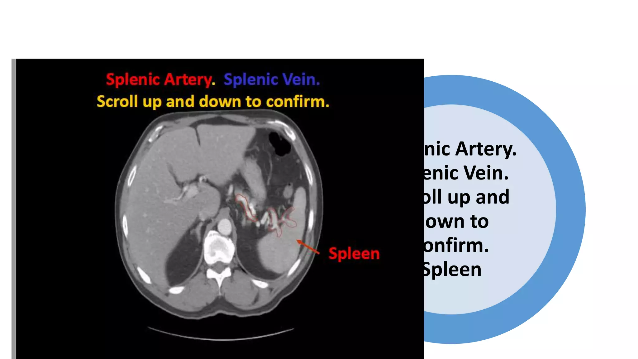 Abdominal CT scan, Triphasic CT scan, Abdominal Anatomy and ...