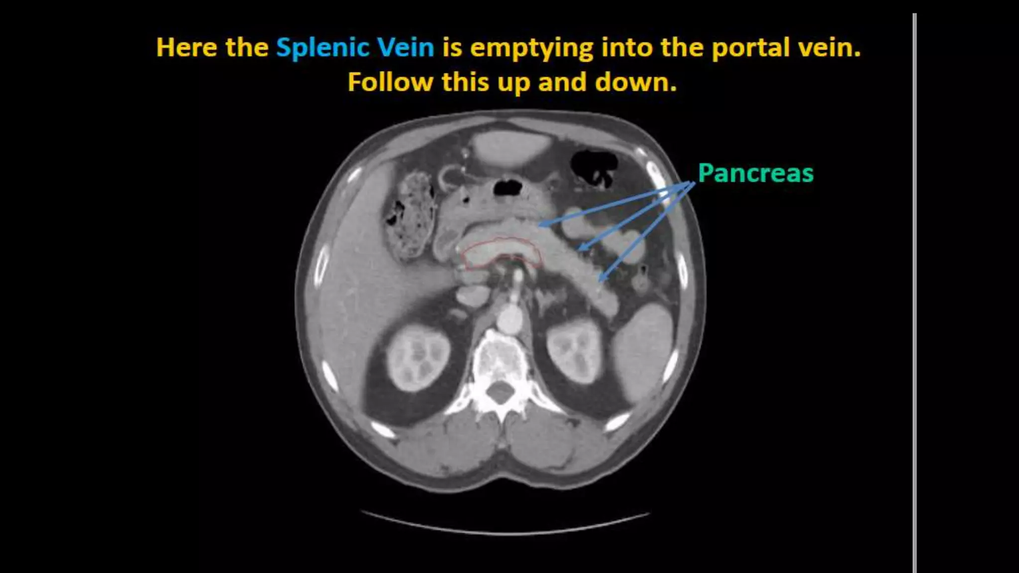Abdominal CT scan, Triphasic CT scan, Abdominal Anatomy and ...