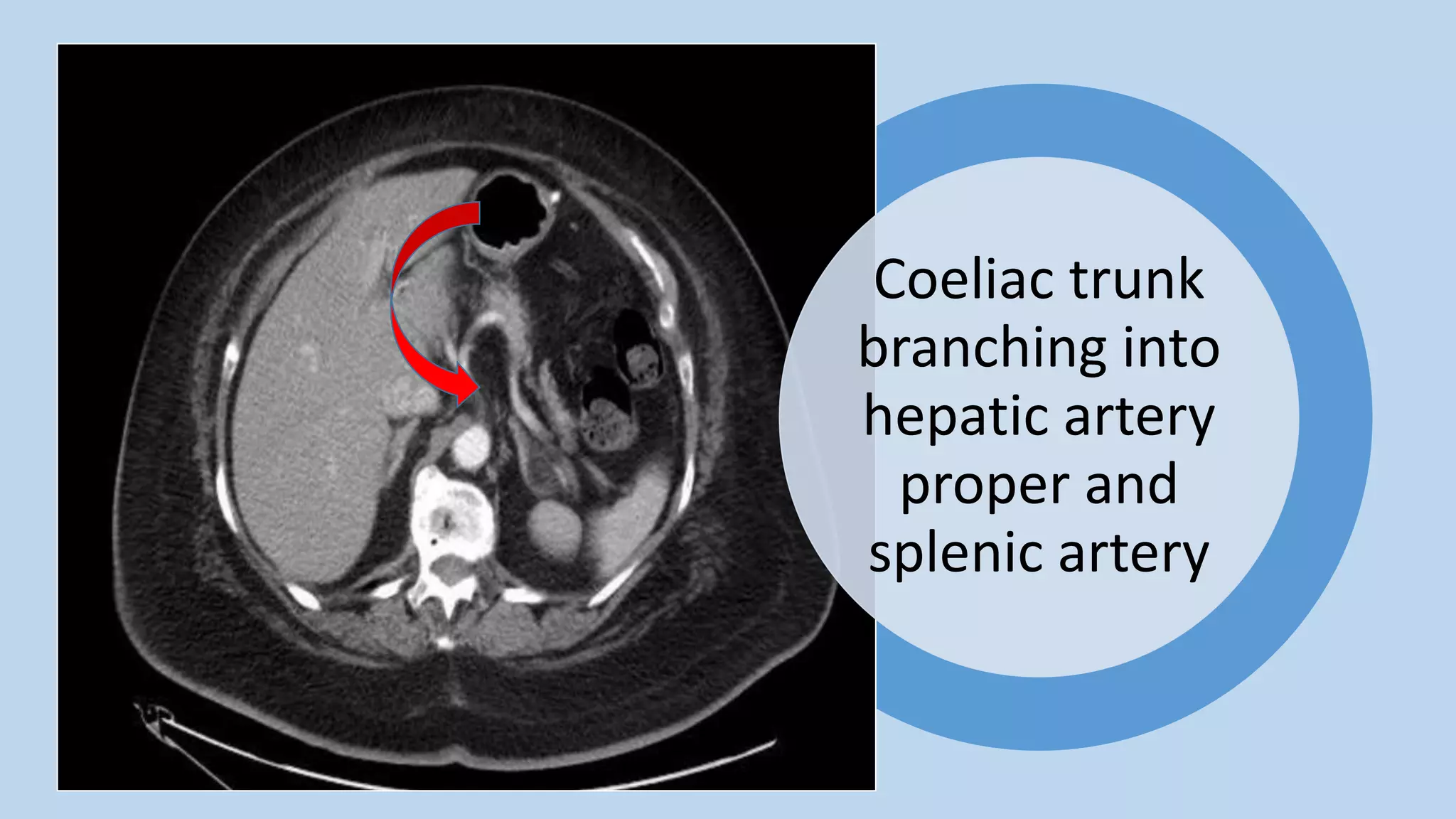Abdominal CT scan, Triphasic CT scan, Abdominal Anatomy and ...