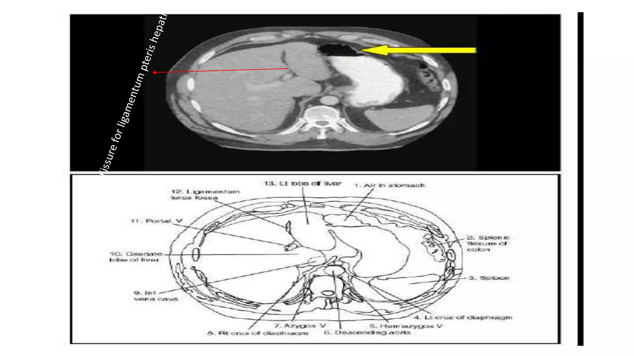 Abdominal CT scan, Triphasic CT scan, Abdominal Anatomy and ...
