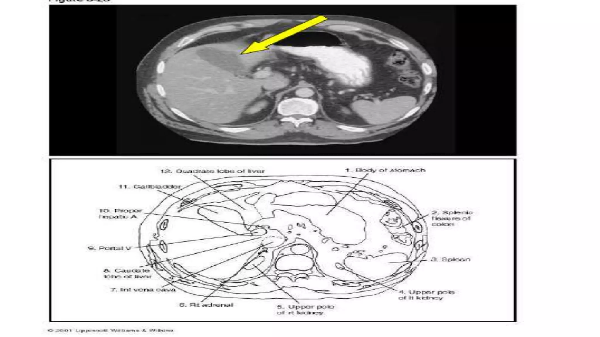 Abdominal CT scan, Triphasic CT scan, Abdominal Anatomy and ...