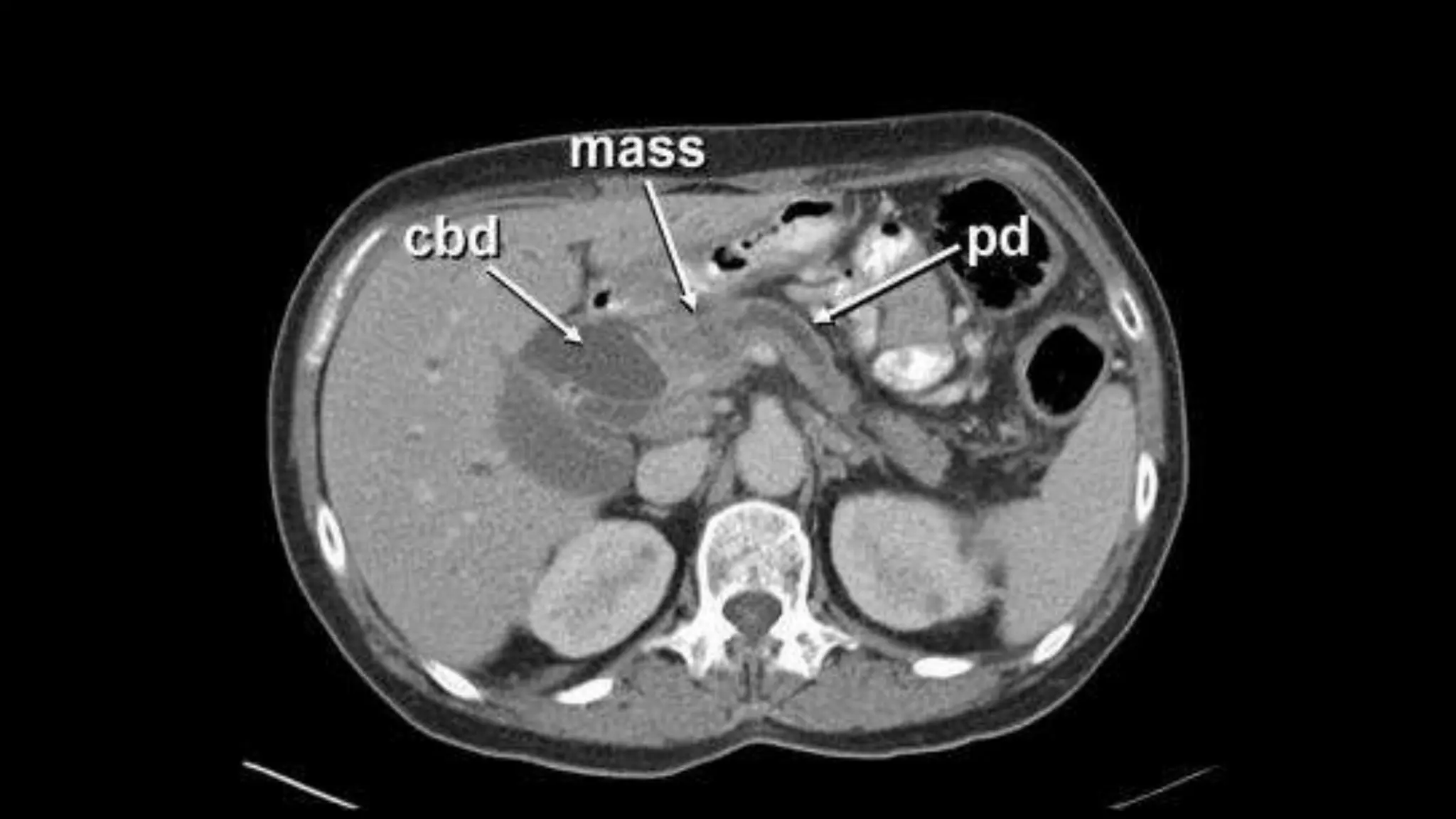 Abdominal CT scan, Triphasic CT scan, Abdominal Anatomy and ...