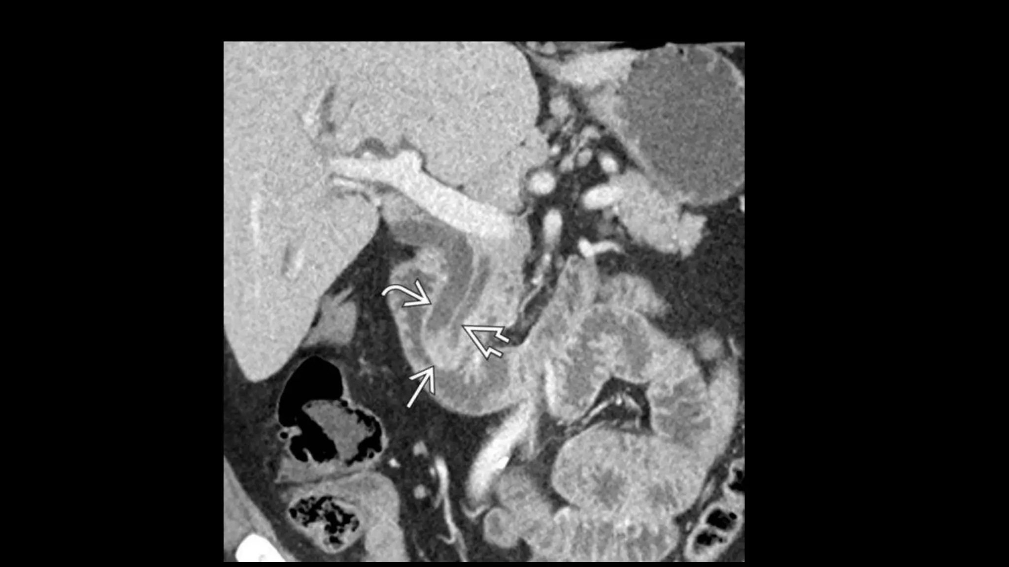 Abdominal CT scan, Triphasic CT scan, Abdominal Anatomy and ...