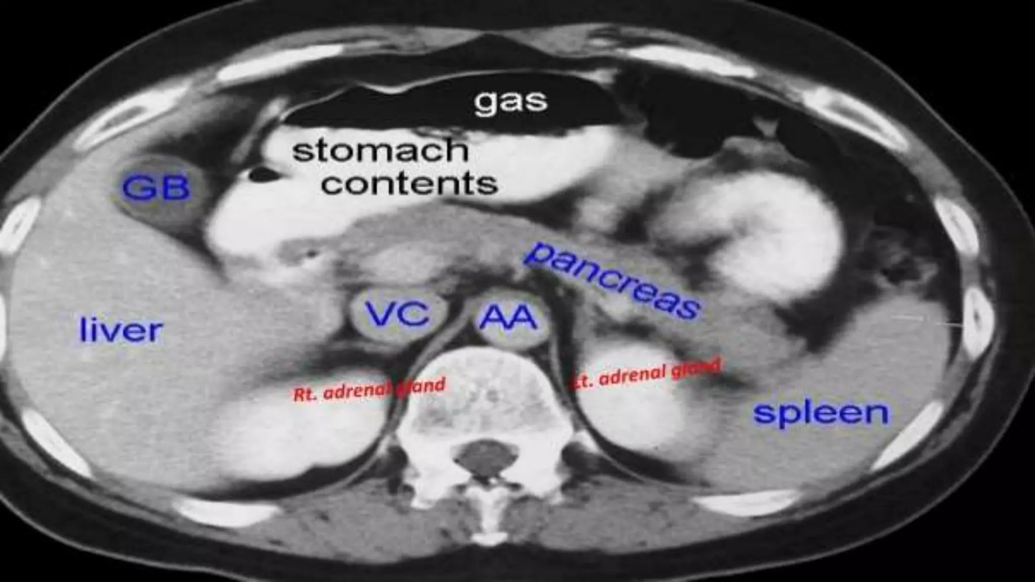 Abdominal CT scan, Triphasic CT scan, Abdominal Anatomy and ...