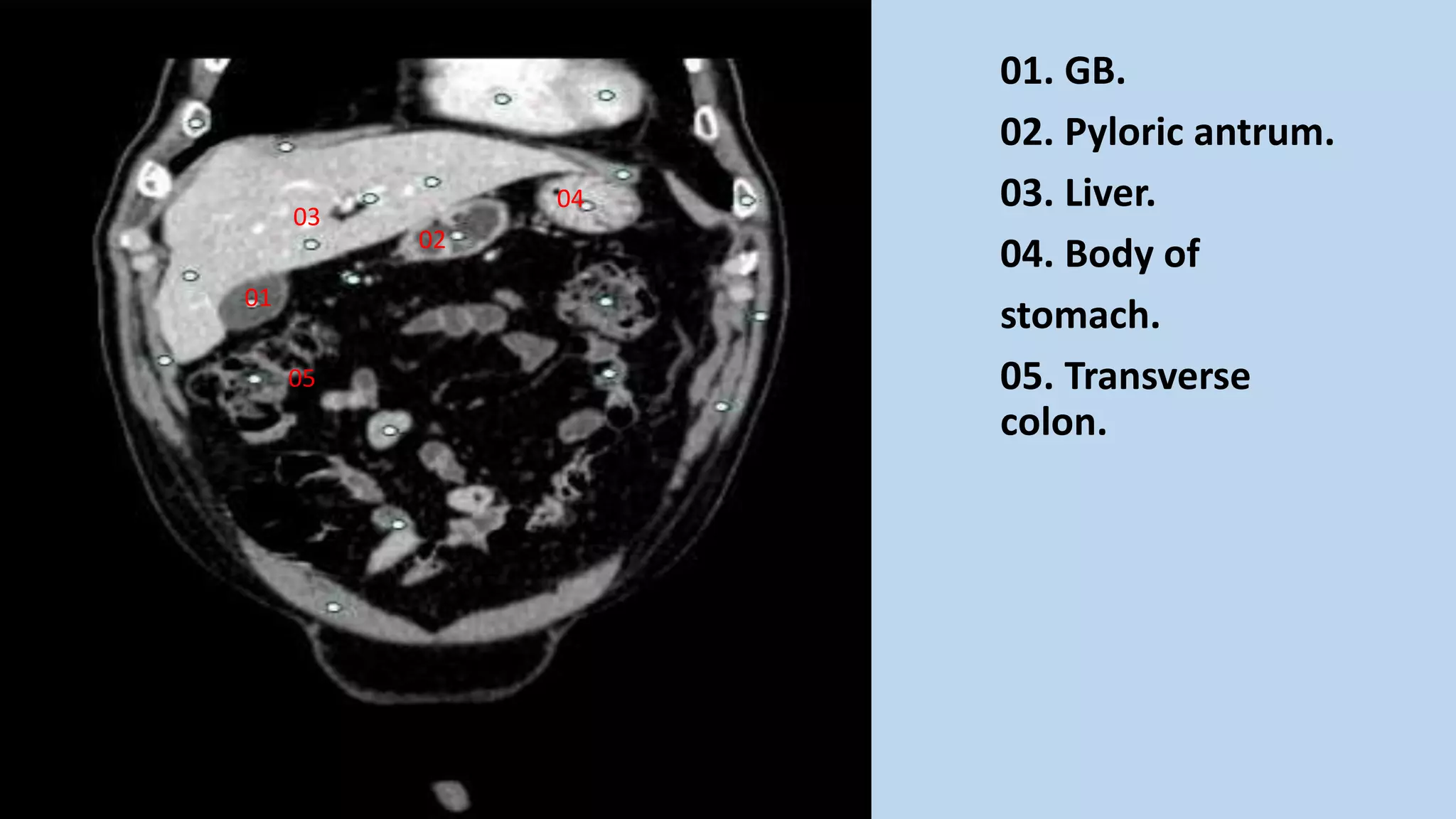 Abdominal CT scan, Triphasic CT scan, Abdominal Anatomy and ...