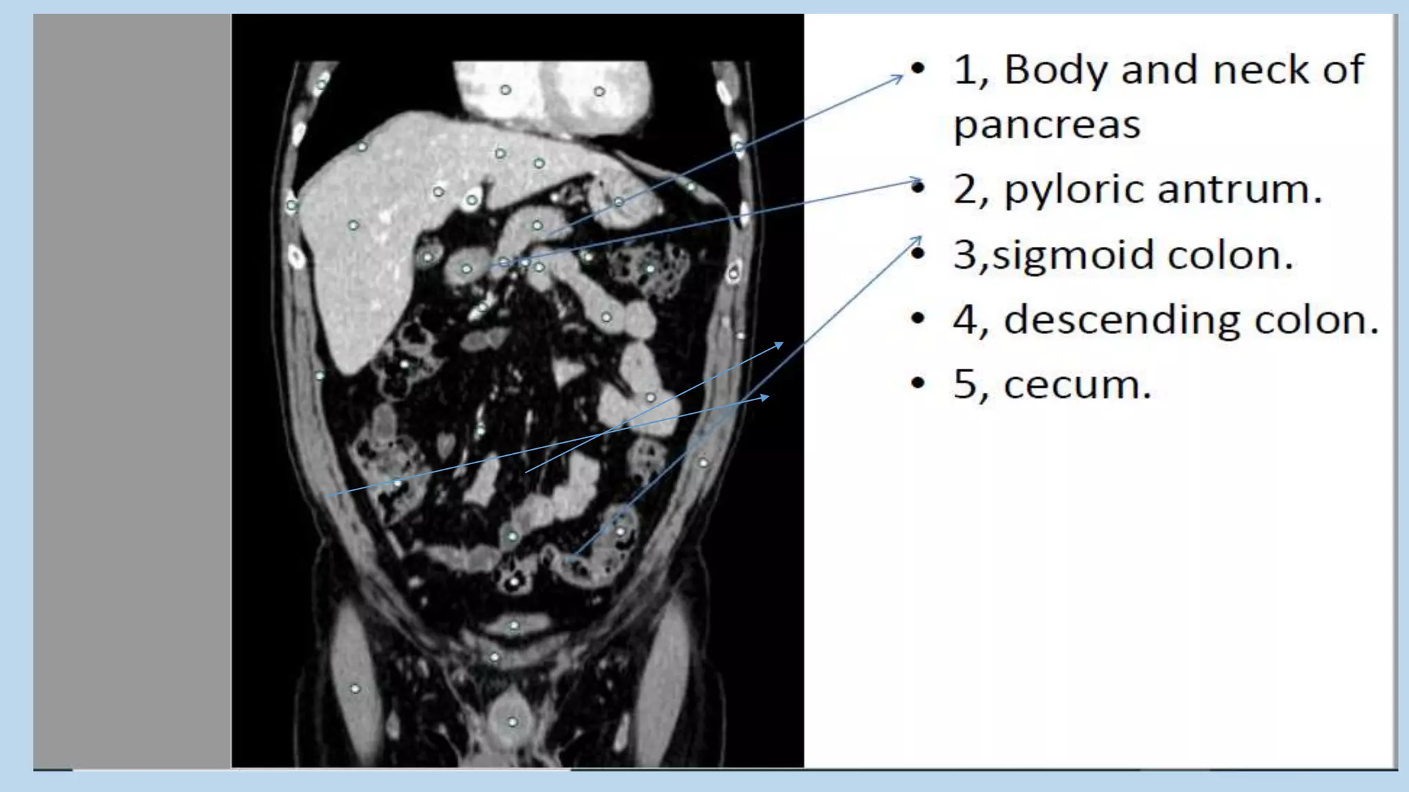 Abdominal CT scan, Triphasic CT scan, Abdominal Anatomy and ...