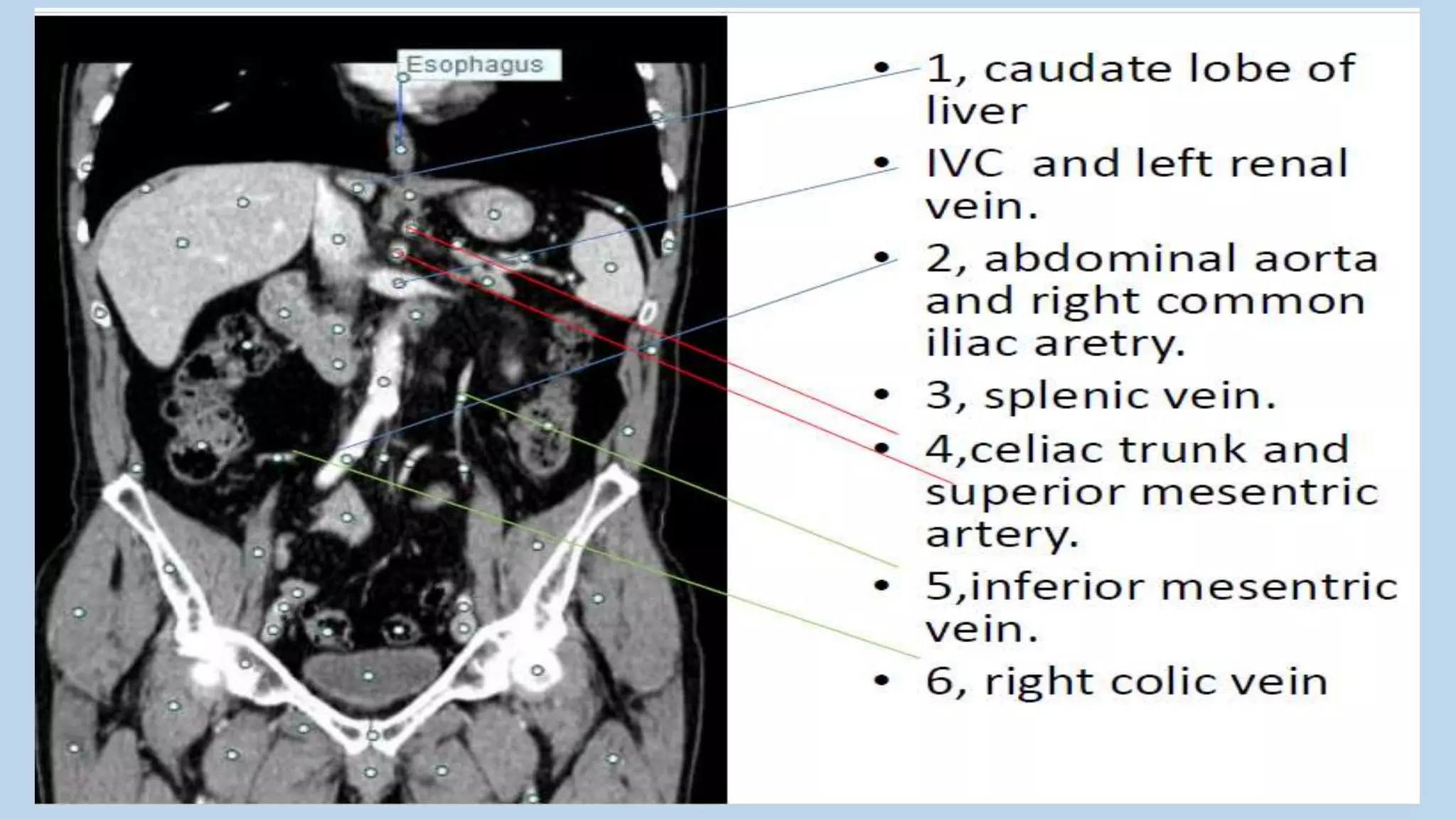 Abdominal CT scan, Triphasic CT scan, Abdominal Anatomy and ...