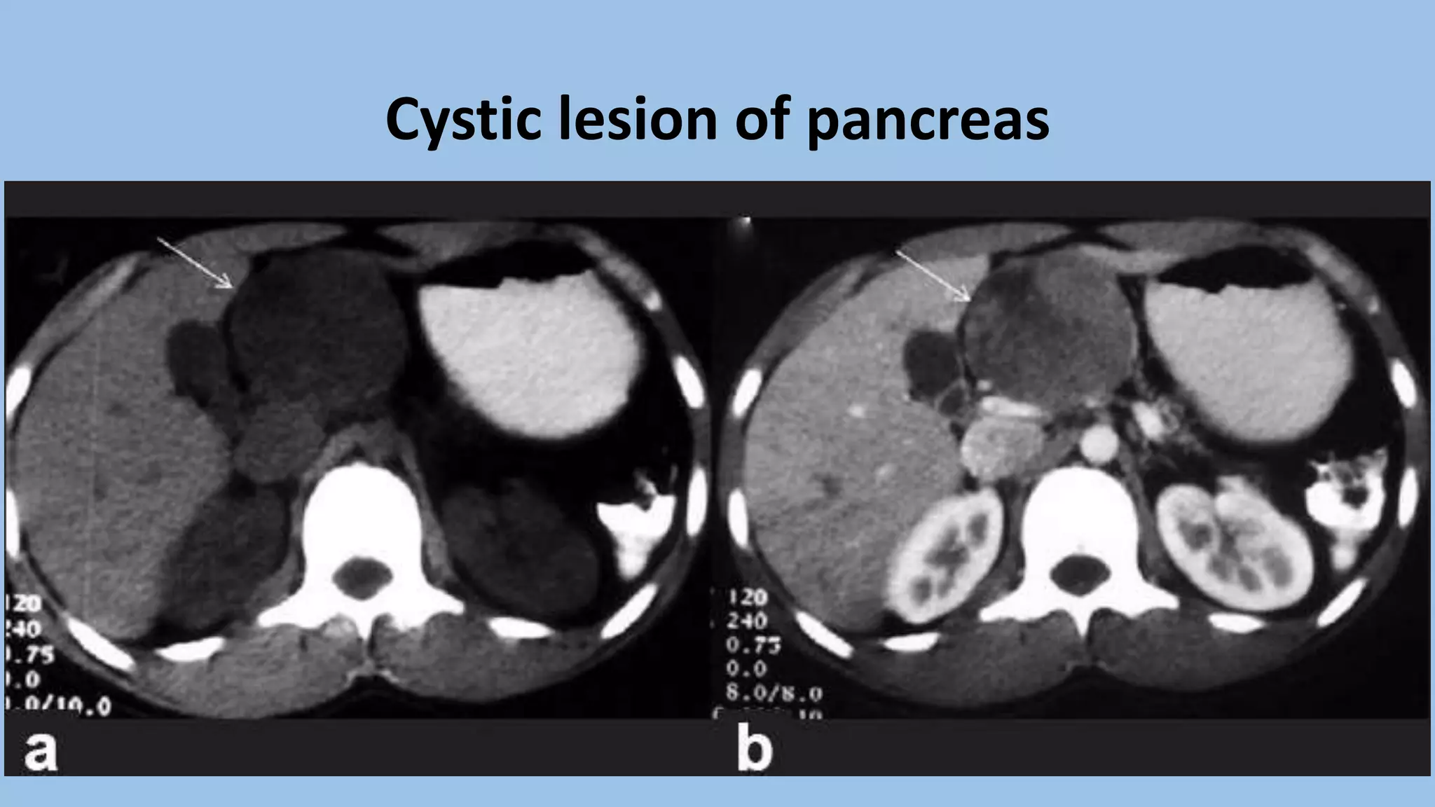 Abdominal CT scan, Triphasic CT scan, Abdominal Anatomy and ...