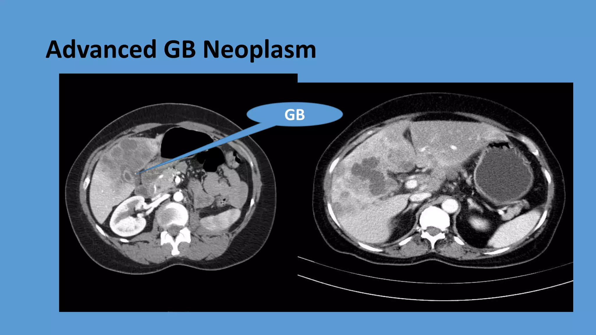 Abdominal CT scan, Triphasic CT scan, Abdominal Anatomy and ...