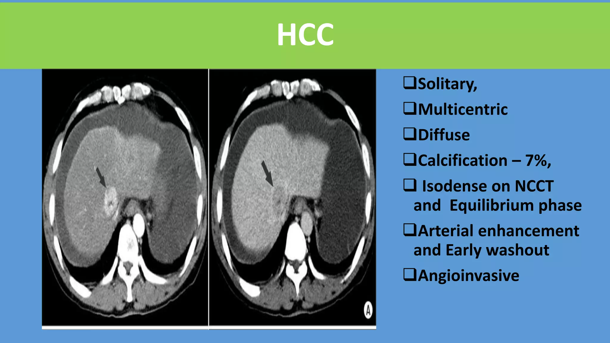 Abdominal CT scan, Triphasic CT scan, Abdominal Anatomy and ...