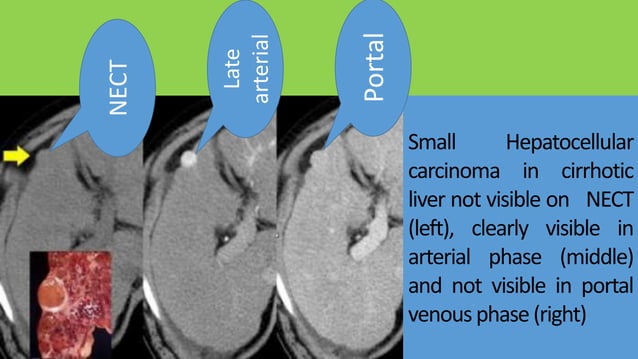 Abdominal CT scan, Triphasic CT scan, Abdominal Anatomy and ...