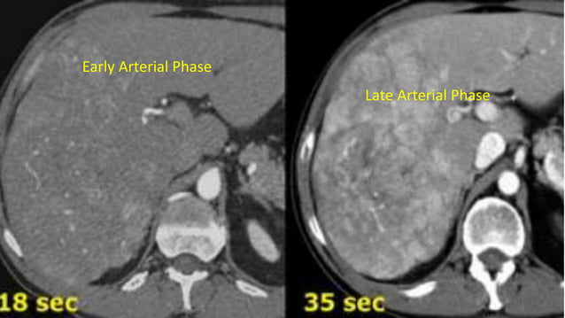 Abdominal CT scan, Triphasic CT scan, Abdominal Anatomy and ...