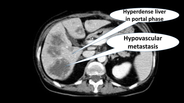 Abdominal CT scan, Triphasic CT scan, Abdominal Anatomy and Hepatobiliary pathology | PPTX