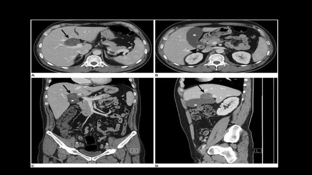 Abdominal CT scan, Triphasic CT scan, Abdominal Anatomy and Hepatobiliary pathology | PPTX