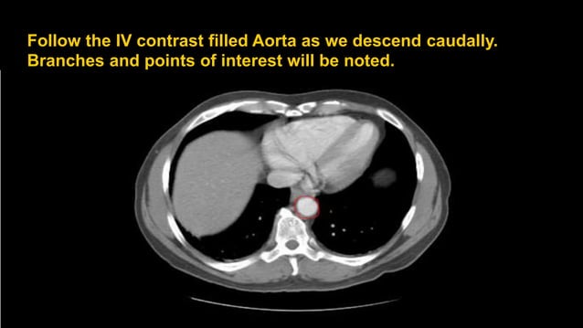 Abdominal CT scan, Triphasic CT scan, Abdominal Anatomy and ...