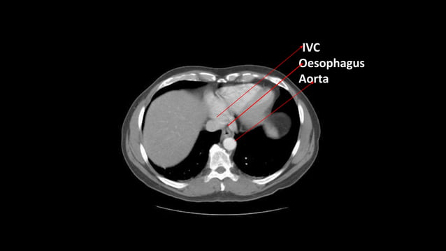 Abdominal CT scan, Triphasic CT scan, Abdominal Anatomy and ...