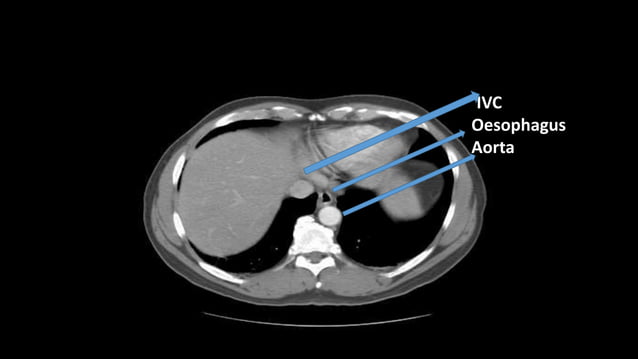 Abdominal CT scan, Triphasic CT scan, Abdominal Anatomy and ...