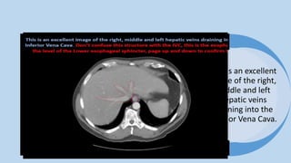 Abdominal CT scan, Triphasic CT scan, Abdominal Anatomy and ...